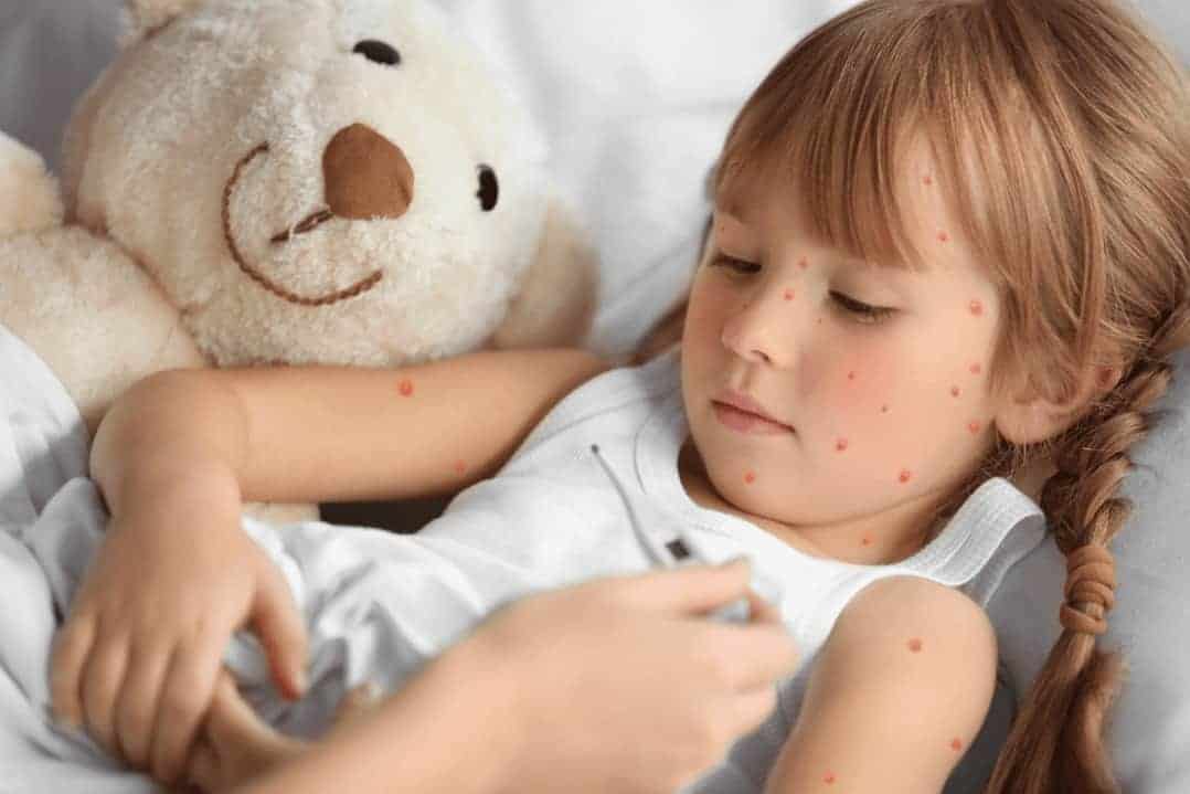 Морбили и у нас! Осигурете си естествена ваксина! - imunitet.bg